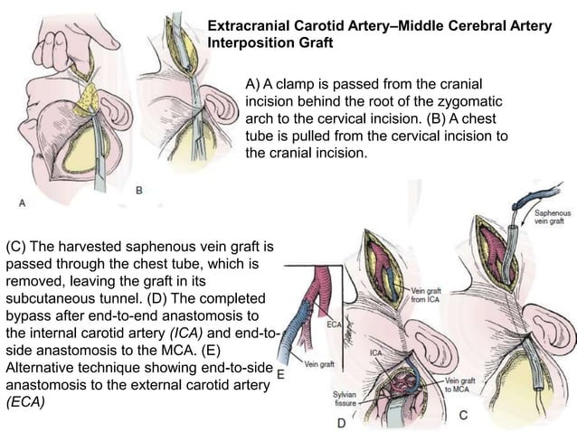 Intracranial Vascular Bypass.pptx