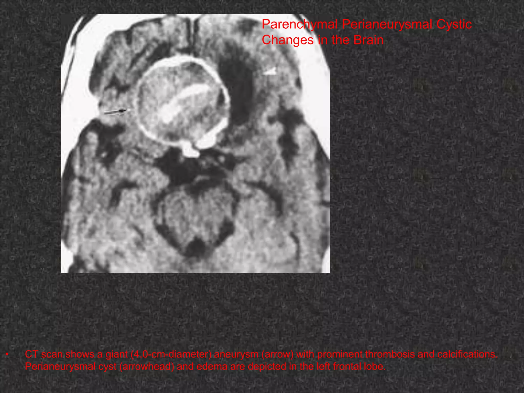 Intracranial vascular cystic lesion Dr Ahmed Esawy CT MRI part 4 | PDF
