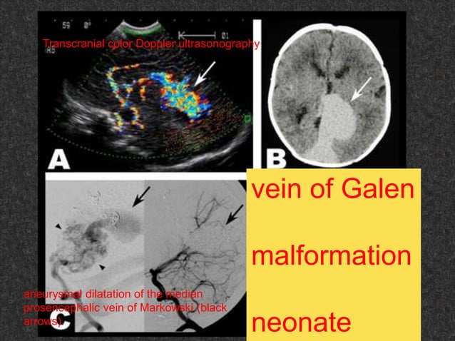 Intracranial vascular cystic lesion Dr Ahmed Esawy CT MRI part 4 | PPT