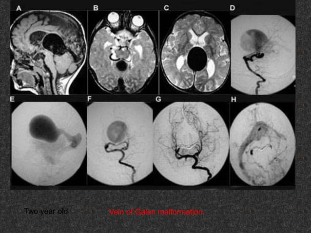 Intracranial vascular cystic lesion Dr Ahmed Esawy CT MRI part 4 | PPT