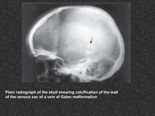 Intracranial vascular cystic lesion Dr Ahmed Esawy CT MRI part 4 | PDF