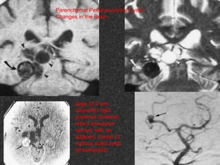 Intracranial vascular cystic lesion Dr Ahmed Esawy CT MRI part 4 | PPT