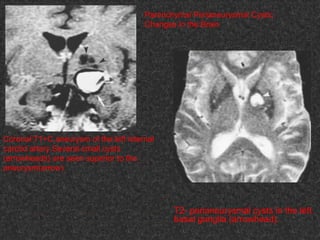 Intracranial vascular cystic lesion Dr Ahmed Esawy CT MRI part 4 | PPT