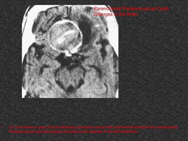 Intracranial vascular cystic lesion Dr Ahmed Esawy CT MRI part 4 | PPT
