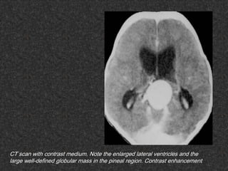 Intracranial vascular cystic lesion Dr Ahmed Esawy CT MRI part 4 | PPT