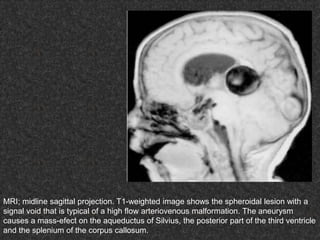 Intracranial vascular cystic lesion Dr Ahmed Esawy CT MRI part 4 | PPT