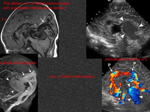 Intracranial vascular cystic lesion Dr Ahmed Esawy CT MRI part 4 | PPT