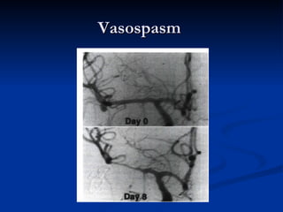 Intracranial vascular disease | PPT