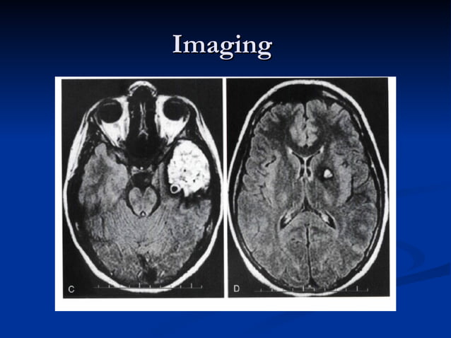 Intracranial vascular disease | PPT | Blood Disorders | Diseases and ...