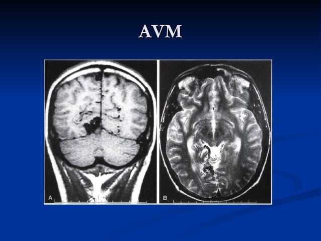 Intracranial vascular disease | PPT | Blood Disorders | Diseases and ...
