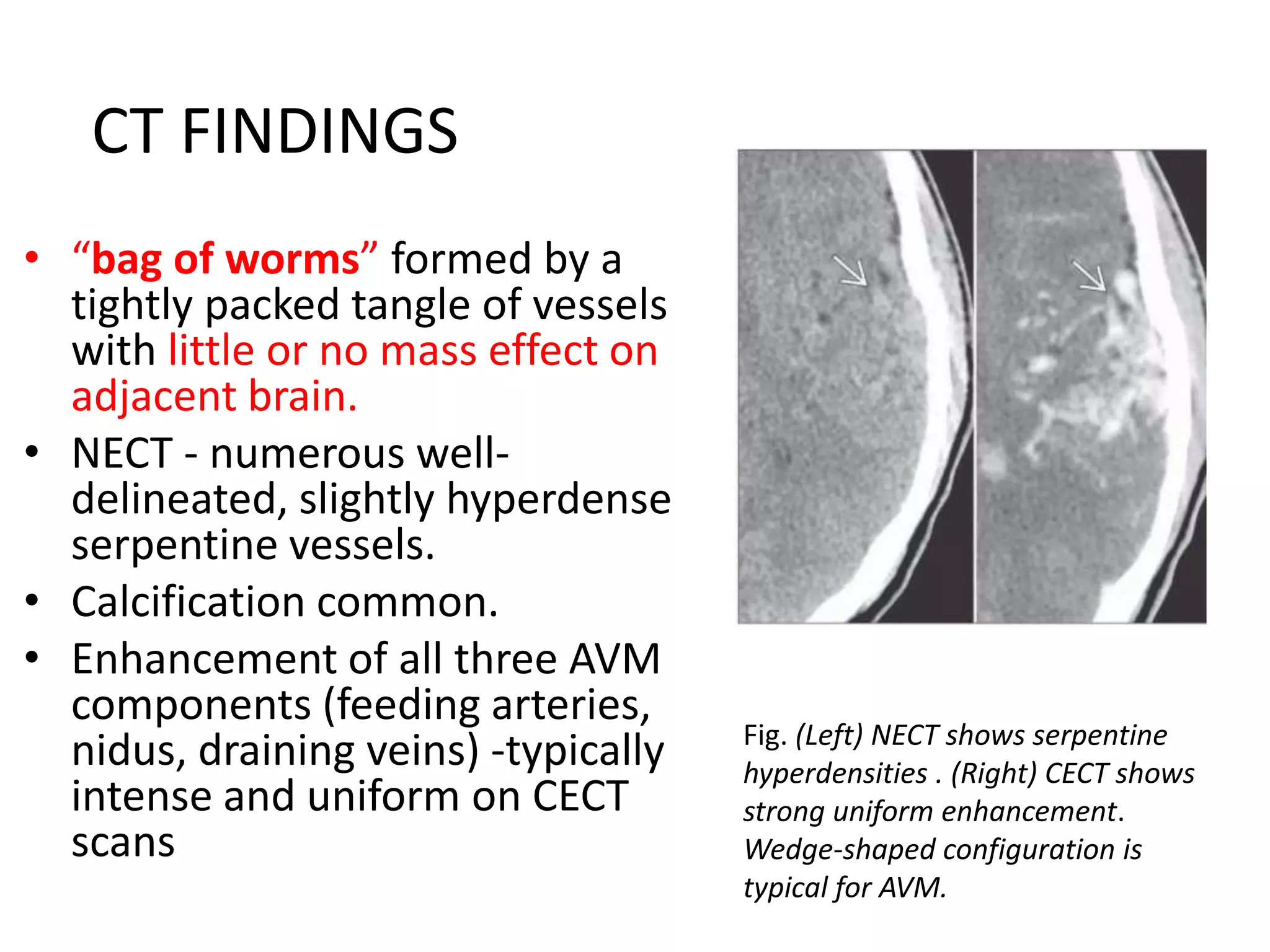 Intracranial vascular malformations | PPTX