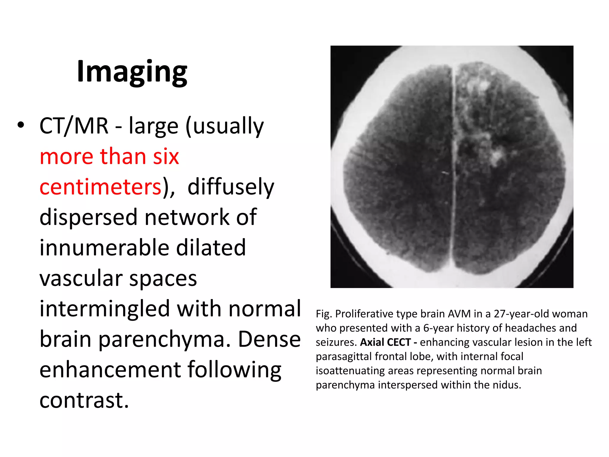 Intracranial vascular malformations | PPTX