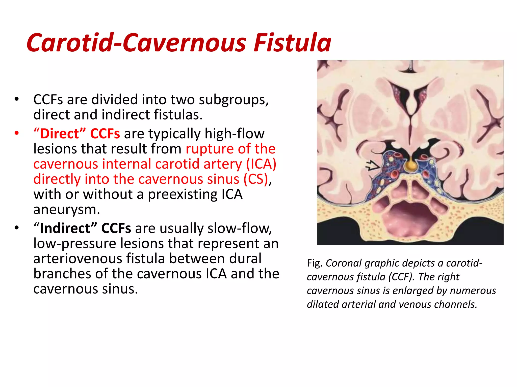 Intracranial vascular malformations | PPTX