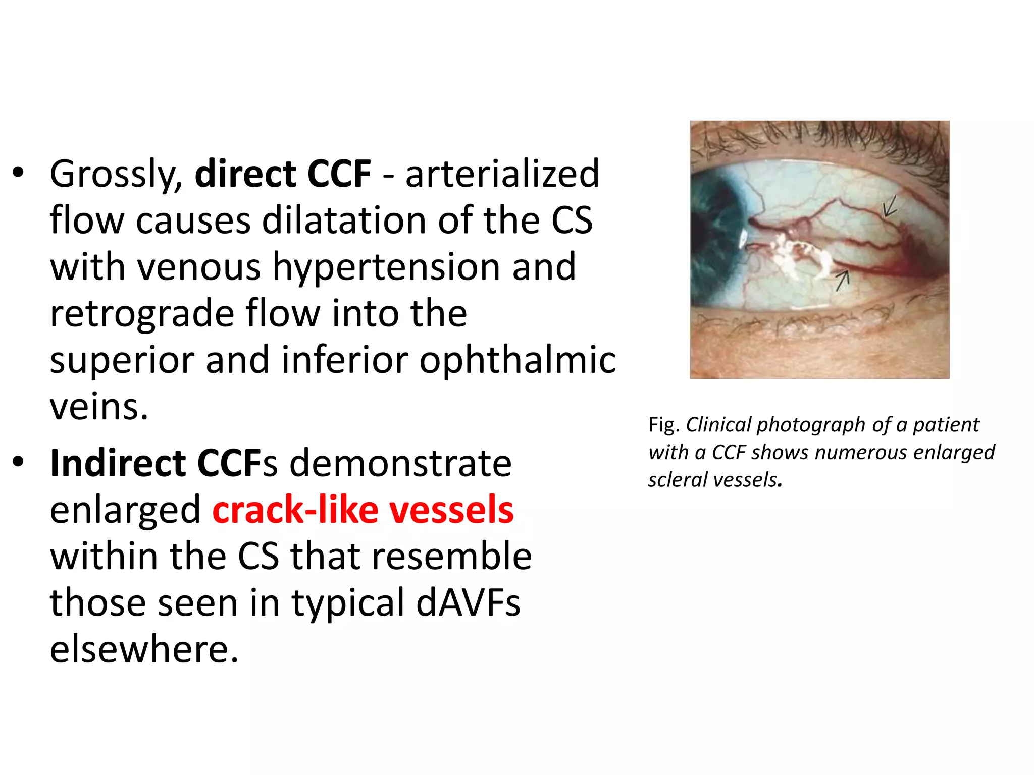 Intracranial vascular malformations | PPTX