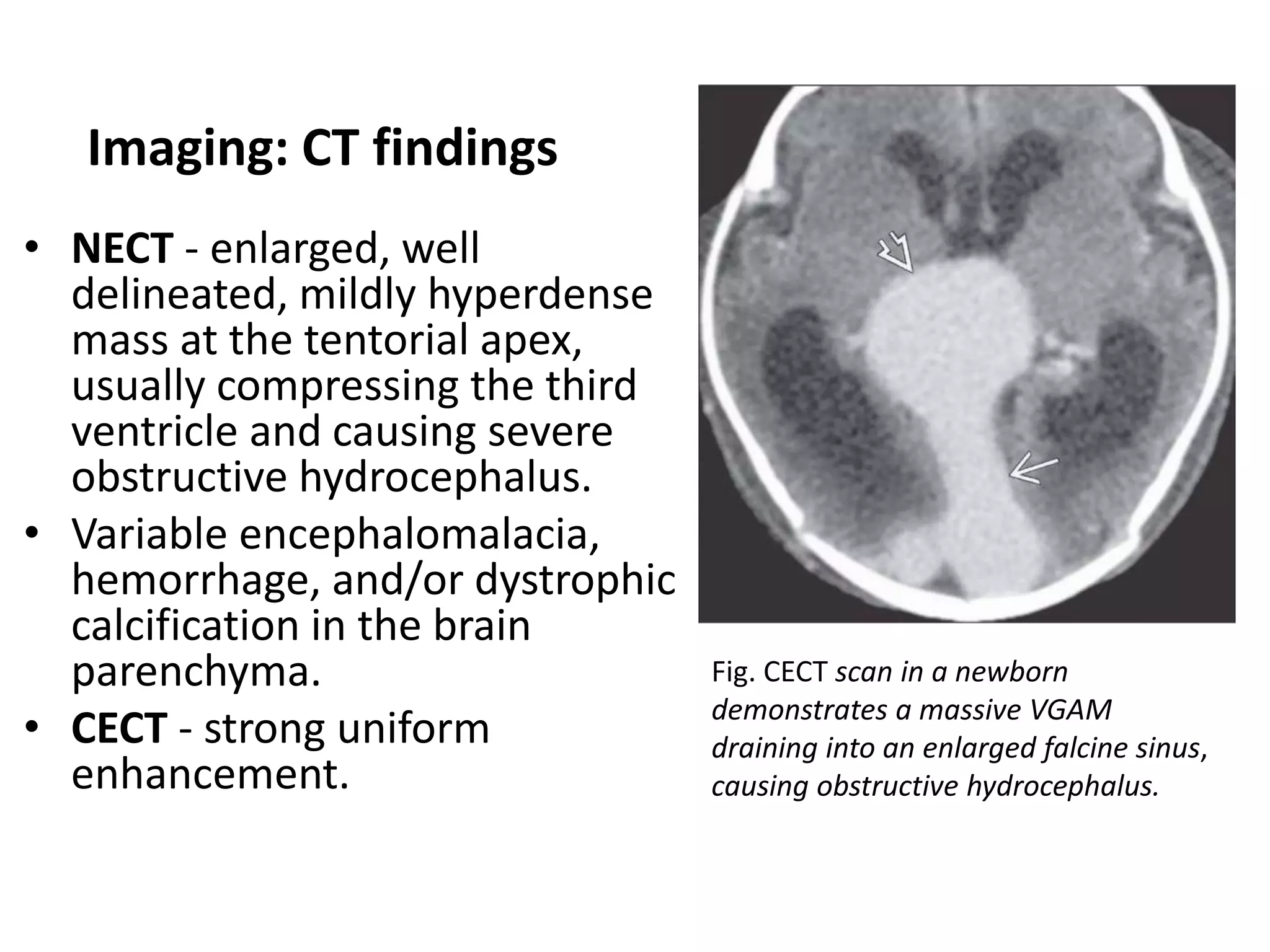 Intracranial vascular malformations | PPTX