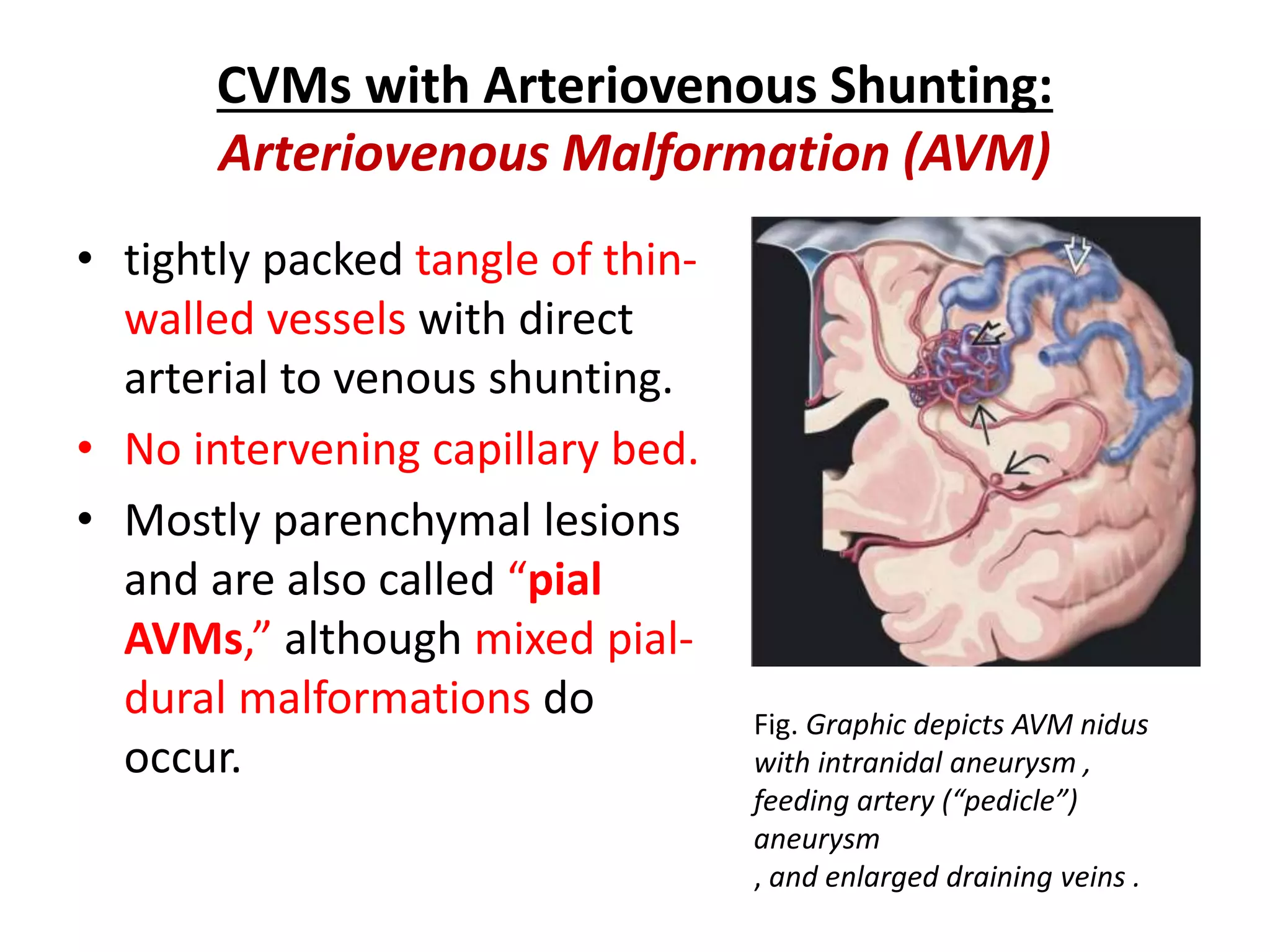 Intracranial vascular malformations | PPTX