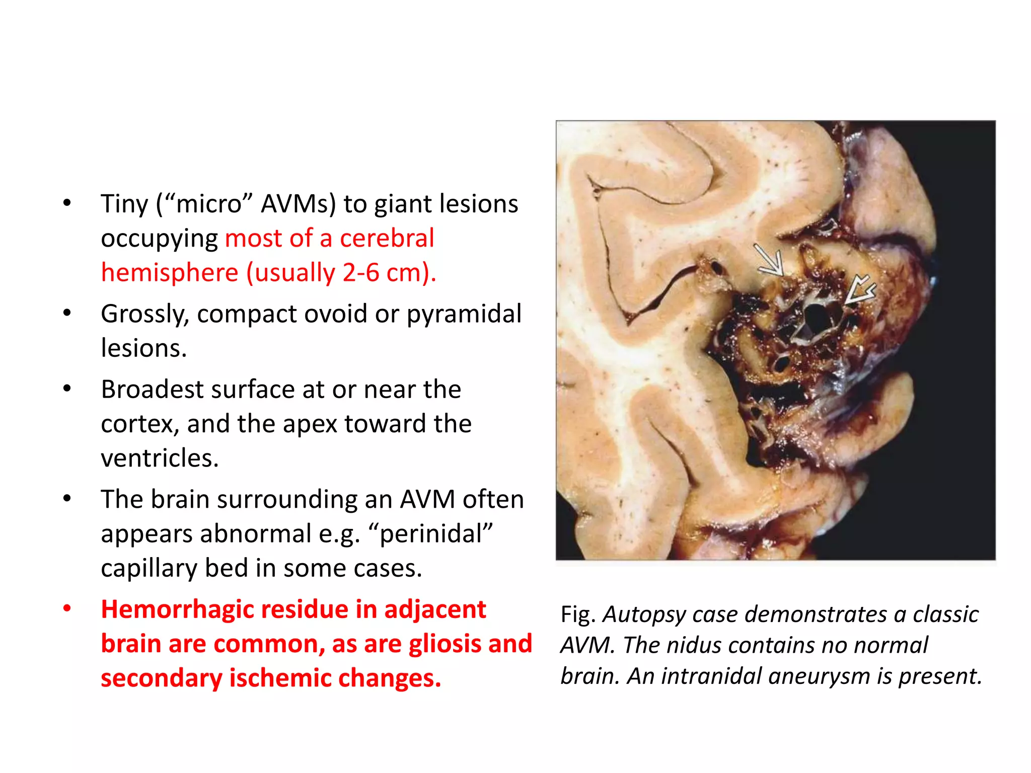 Intracranial vascular malformations | PPTX