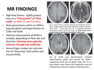 Intracranial vascular malformations | PPTX