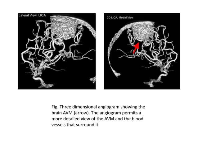 Intracranial Vascular Malformations Pptx
