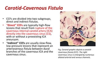 Intracranial vascular malformations | PPTX