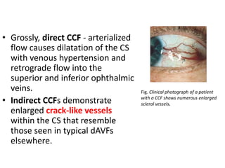Intracranial vascular malformations | PPTX