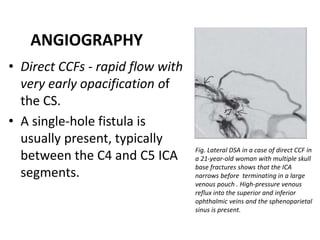 Intracranial vascular malformations | PPTX