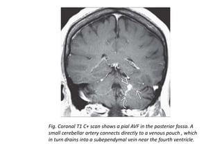 Intracranial vascular malformations | PPTX