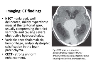 Intracranial vascular malformations | PPTX