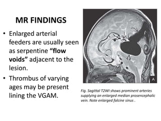 Intracranial vascular malformations | PPTX