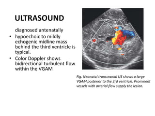 Intracranial vascular malformations | PPTX