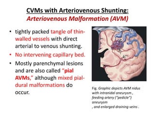 Intracranial vascular malformations | PPTX
