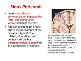 Intracranial vascular malformations | PPTX