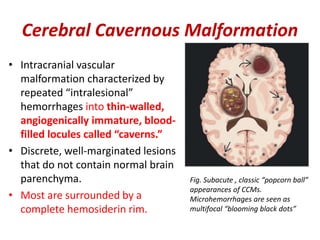 Intracranial vascular malformations | PPTX
