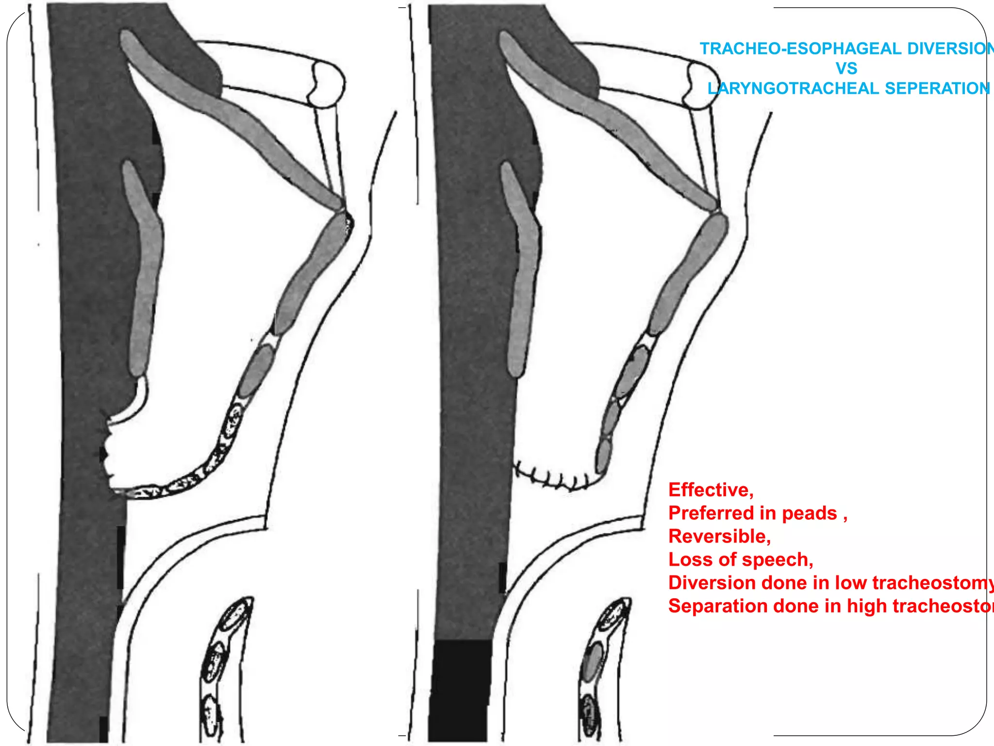 Intractable aspiration | PPTX