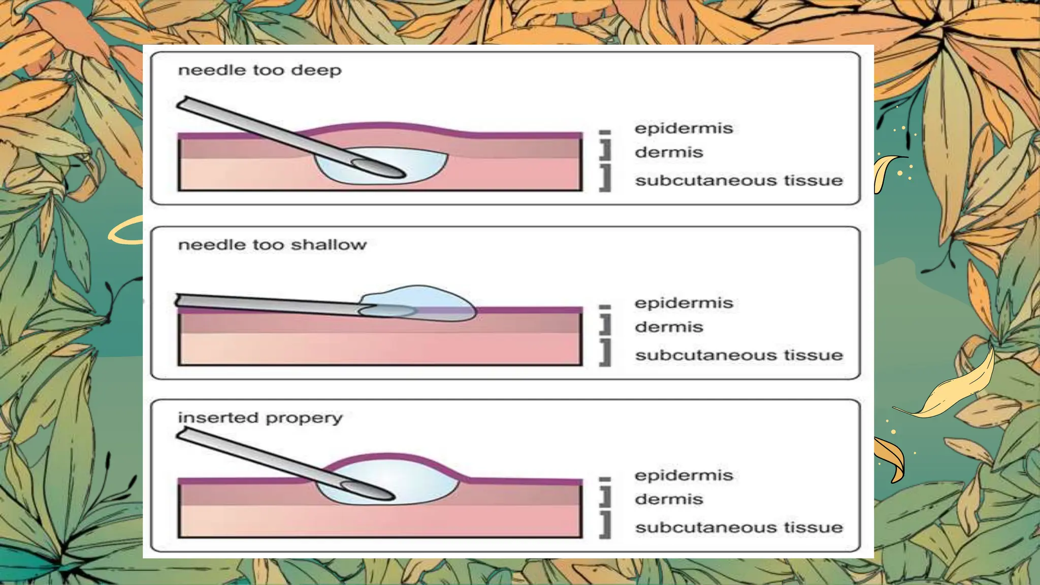 INTRADERMAL INJECTION DESCRIPTION WITH PROCESS | PPTX