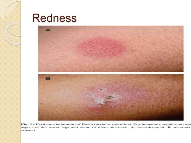 Intradermal injection- Introduction, procedure,complications | PPTX