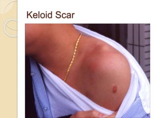 Intradermal injection- Introduction, procedure,complications | PPTX