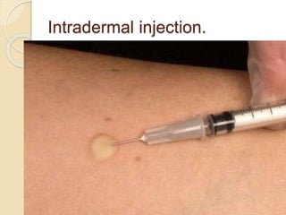 Intradermal injection- Introduction, procedure,complications | PPTX