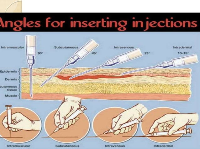 Intradermal injection- Introduction, procedure,complications | PPTX