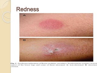 Intradermal injection- Introduction, procedure,complications | PPT