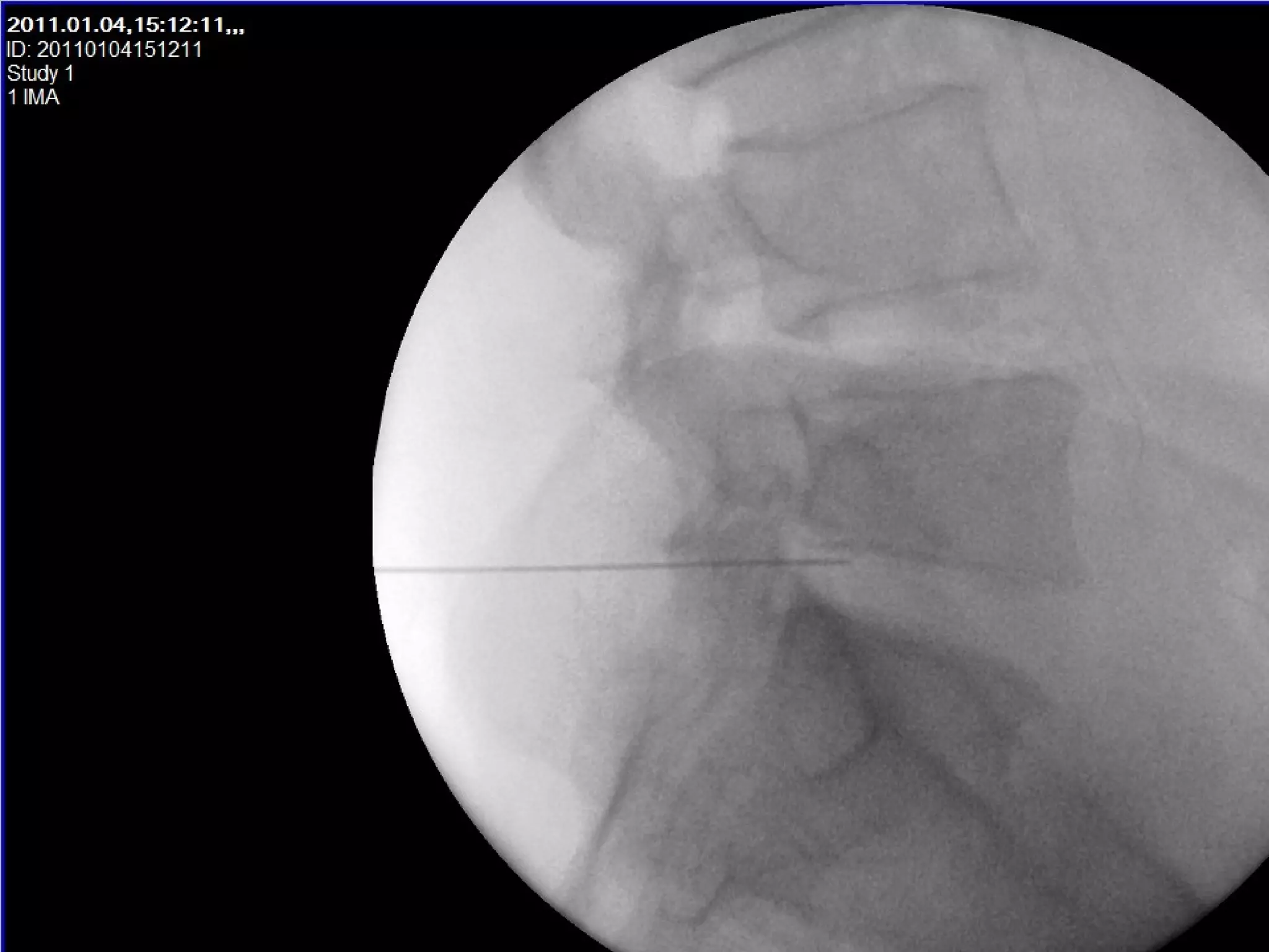 Intradiscal ozone and trans foraminal injections | PPT