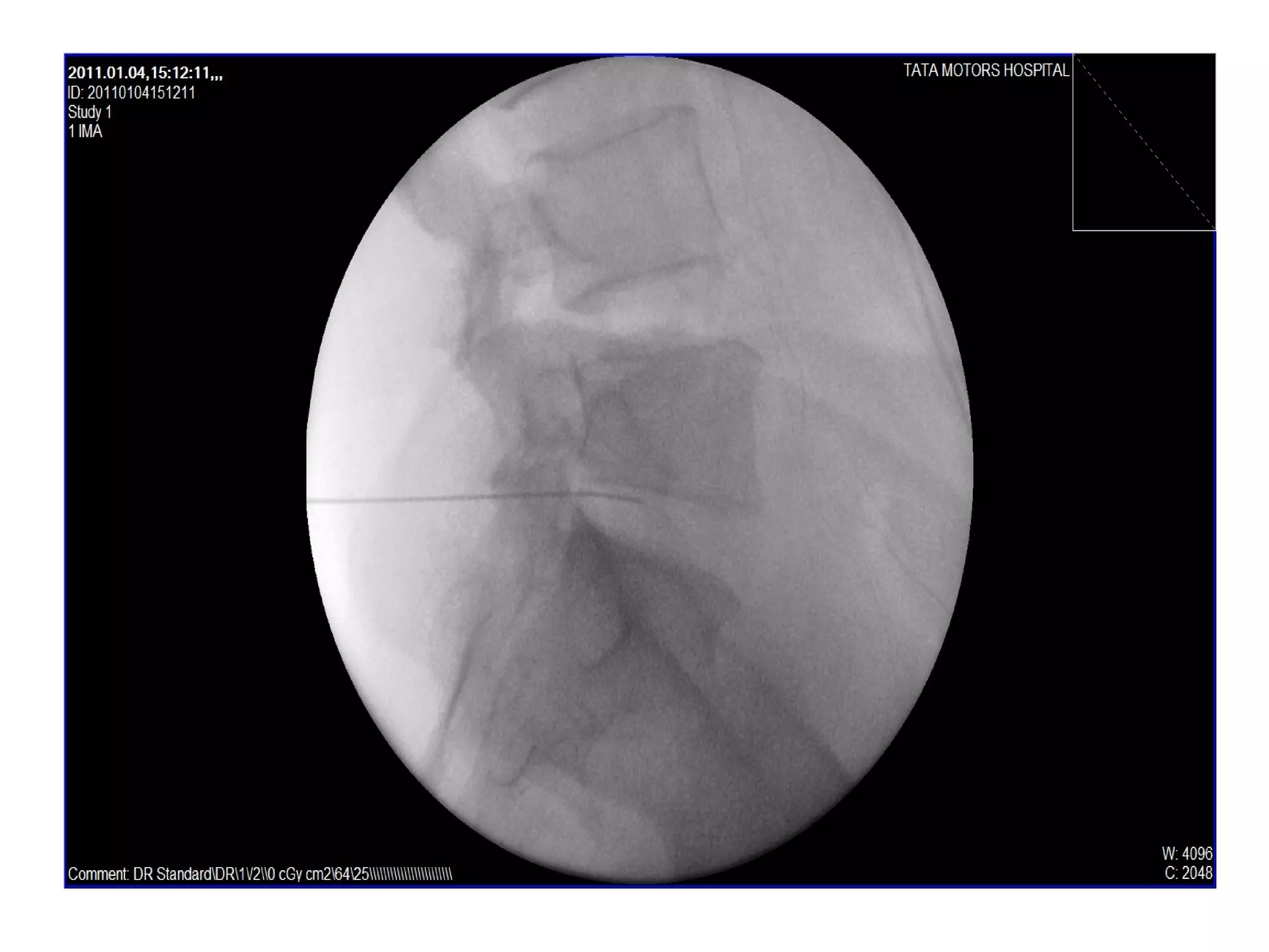 Intradiscal ozone and trans foraminal injections | PPT
