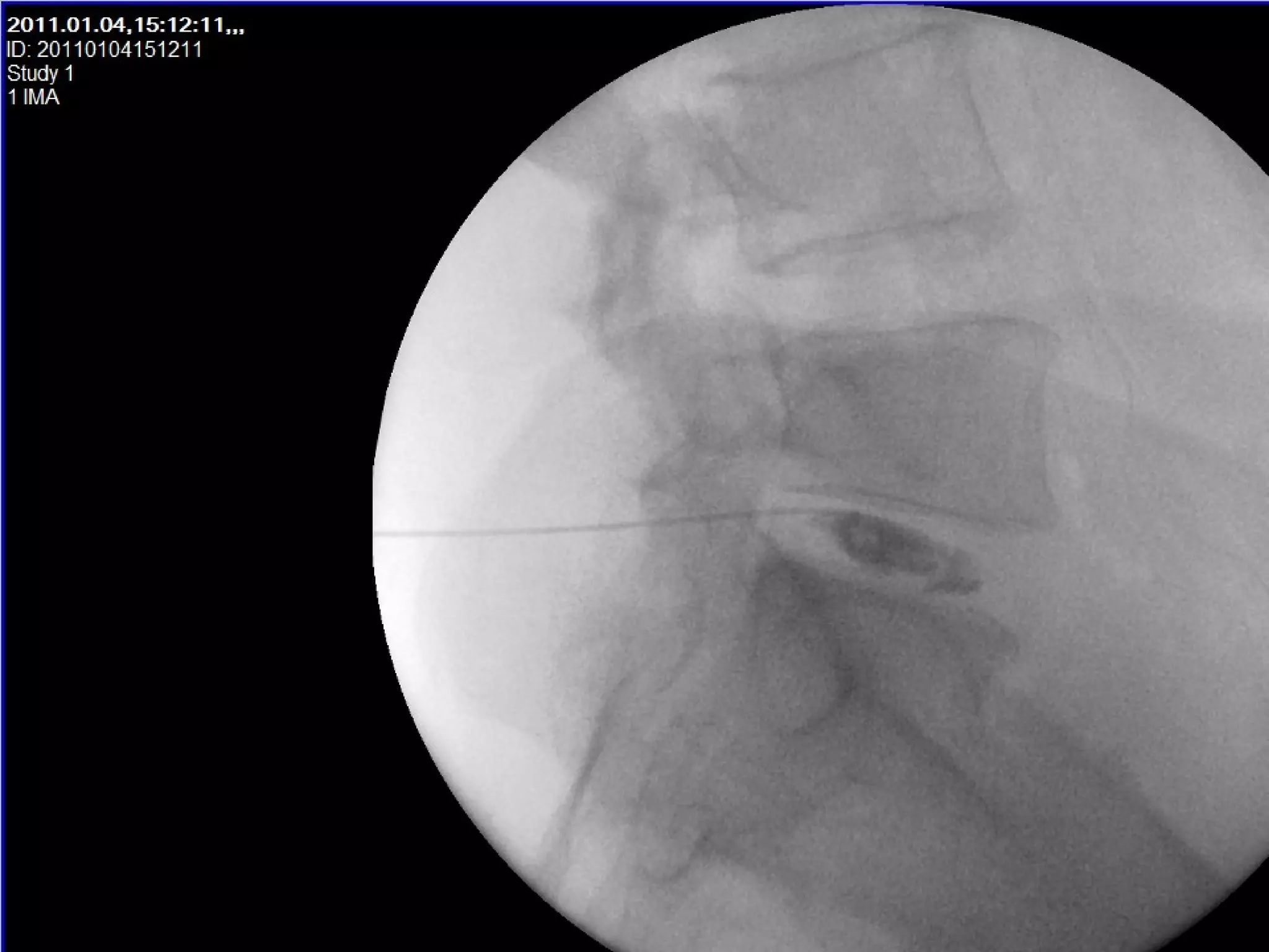 Intradiscal ozone and trans foraminal injections | PPT