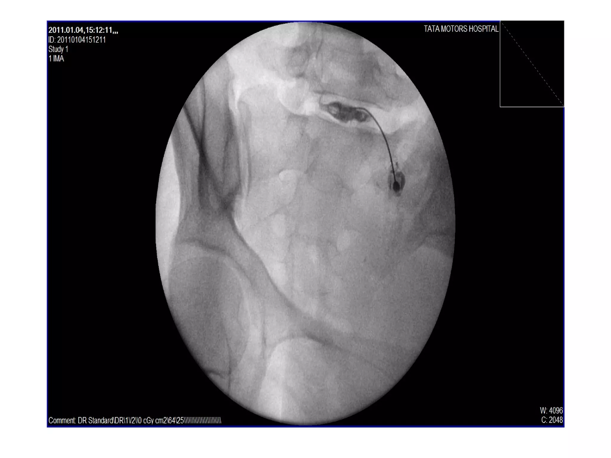 Intradiscal ozone and trans foraminal injections | PPT
