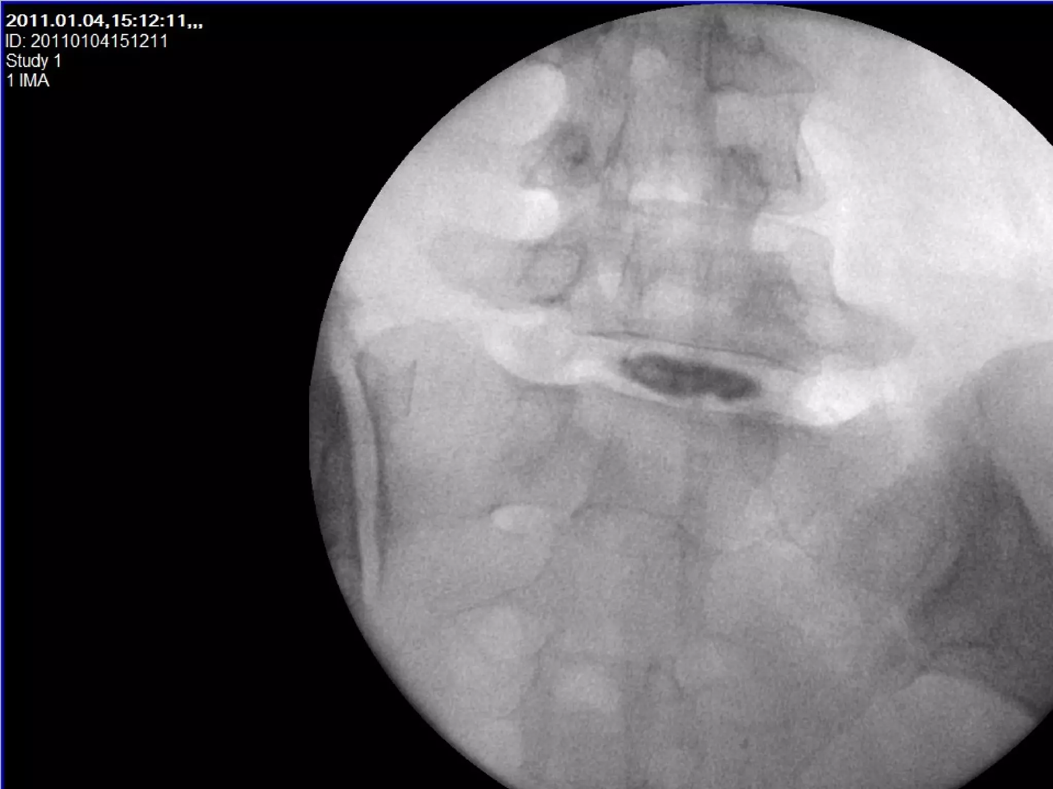Intradiscal ozone and trans foraminal injections | PPT