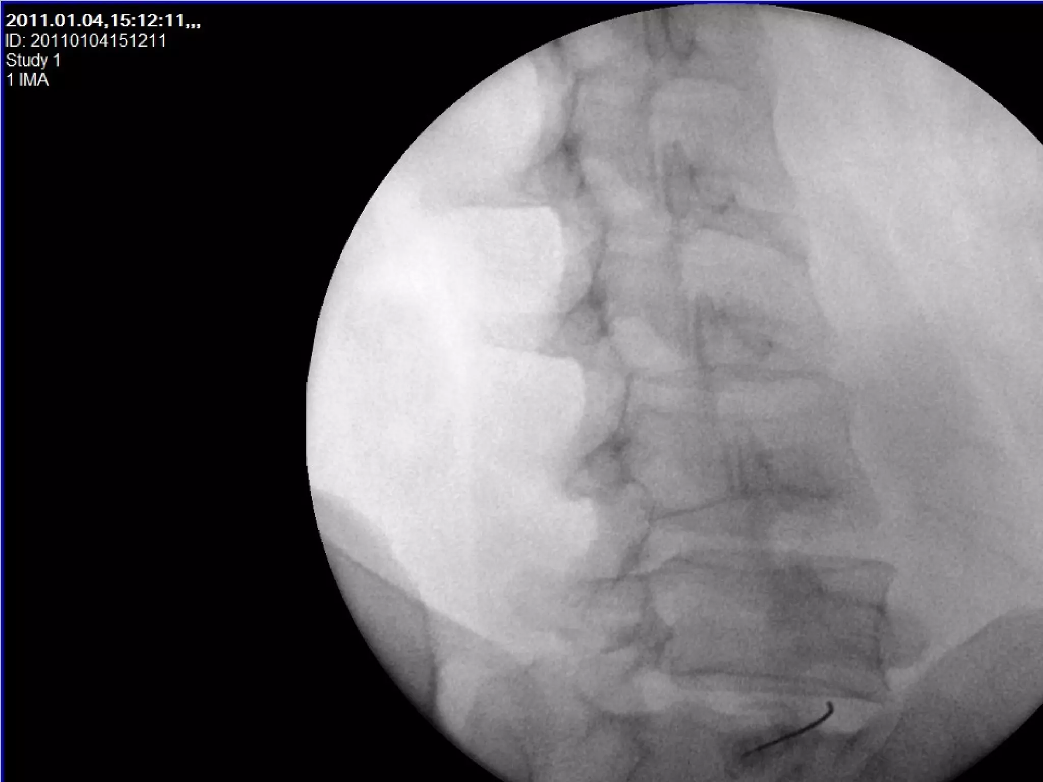 Intradiscal ozone and trans foraminal injections | PPT