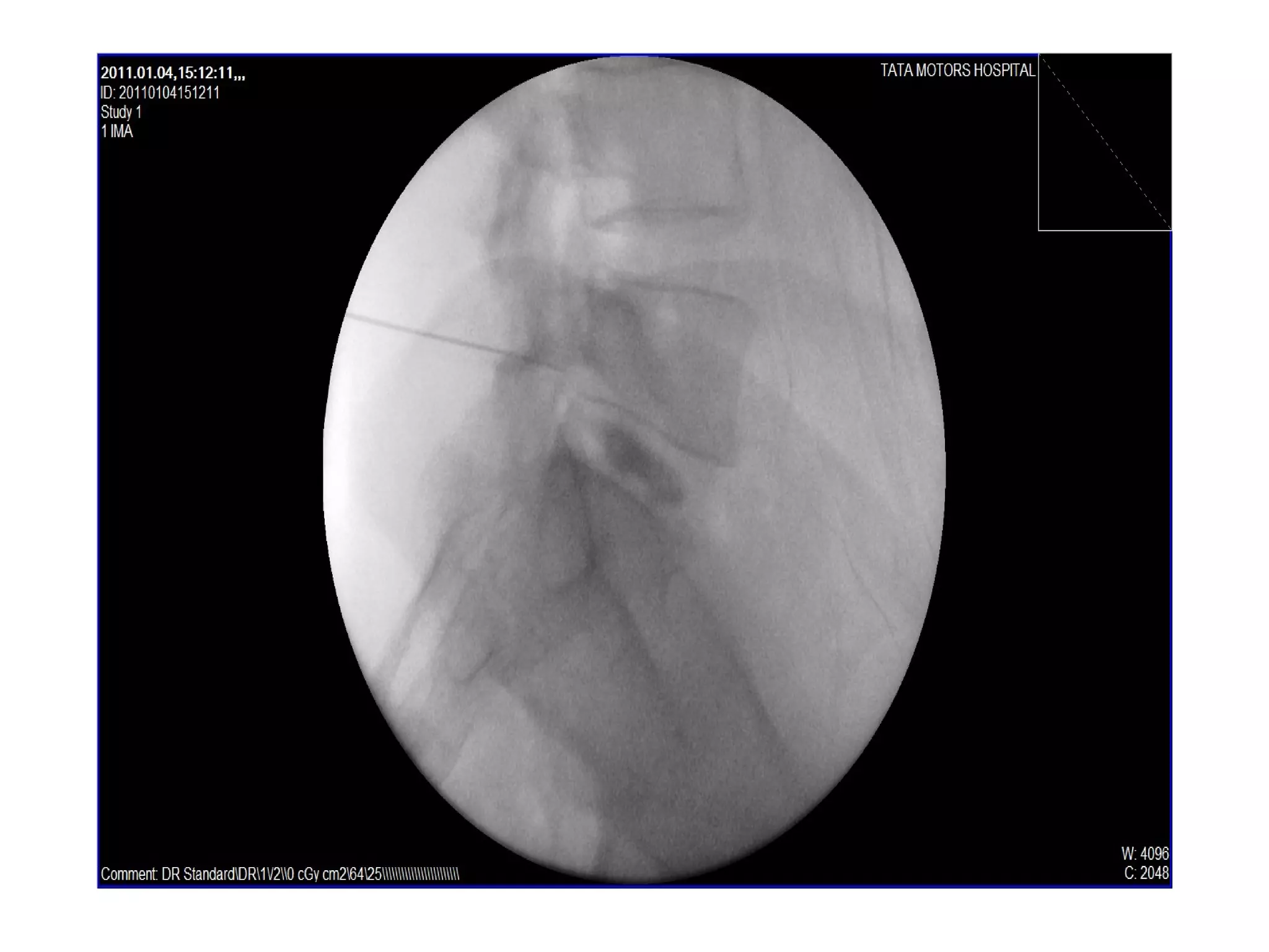 Intradiscal ozone and trans foraminal injections | PPT