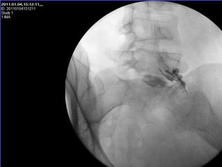 Intradiscal ozone and trans foraminal injections | PPT