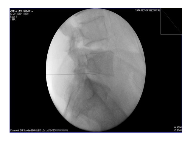 Intradiscal ozone and trans foraminal injections | PPT