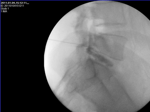 Intradiscal ozone and trans foraminal injections | PPT